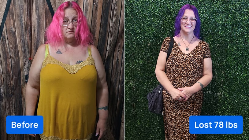 Gastric Band Removal – Procedure, Recovery & Side Effects